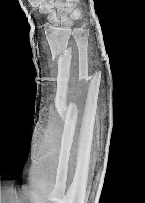 Fractured arm bone: Broken arm – Symptoms and causes