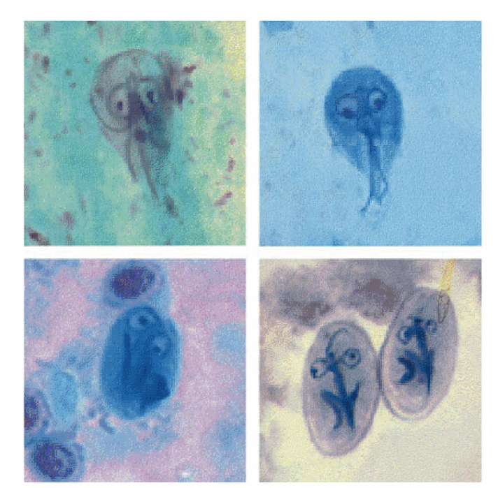Giardia prognosis: What is the prognosis of giardiasis?