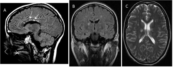 White brain matter on mri. White Matter Disease: Causes, Symptoms, and ...