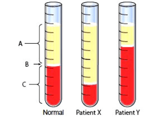 What is hematocrit test for: Hematocrit Test: MedlinePlus Medical Test